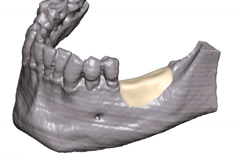 Workflow – botiss bonebuilder